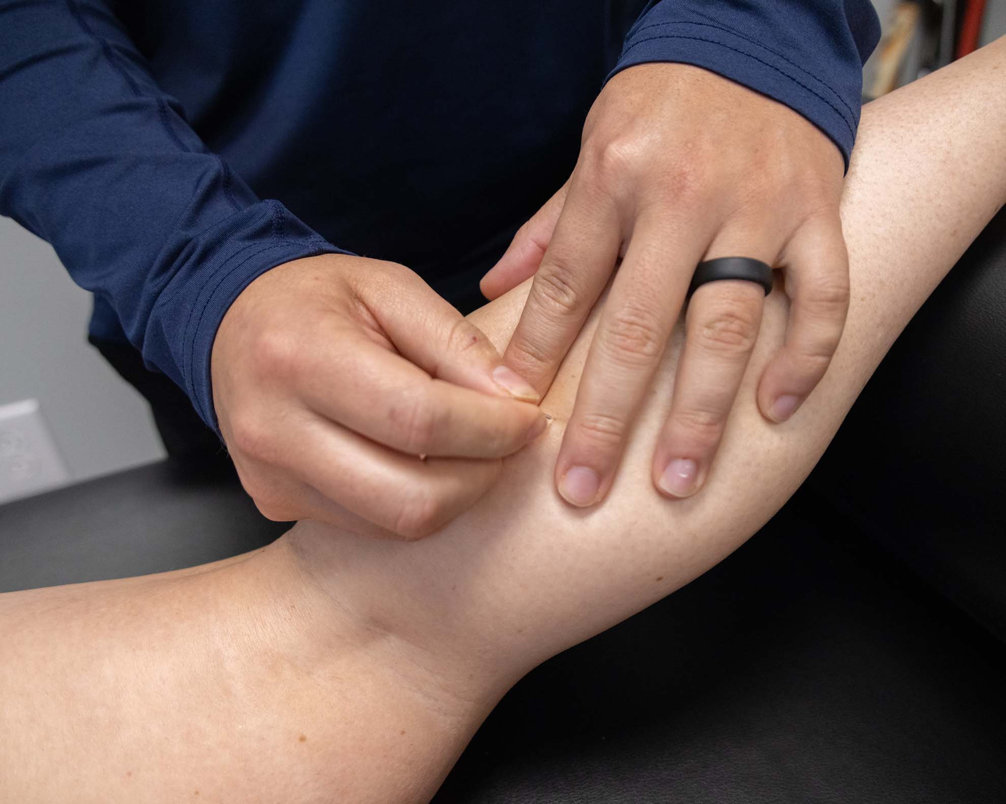 Dry Needling | Raines Physical Therapy